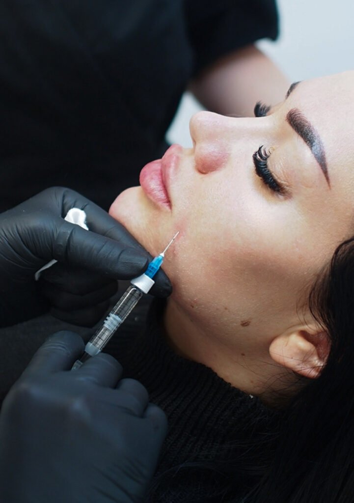 Marionette Lines Treatment | Marionette Lines Filler in London