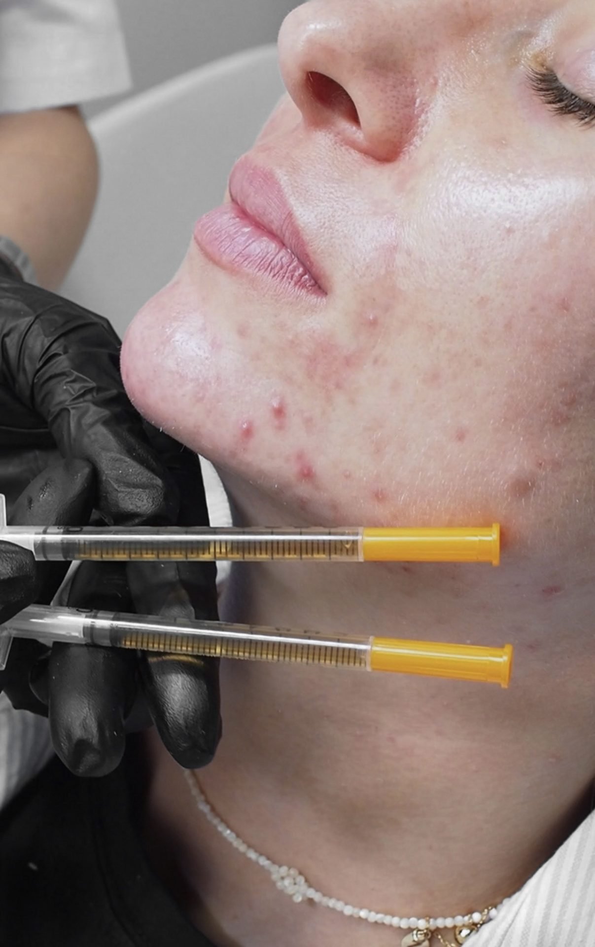 Placenta Therapy London | Placenta Cell Therapy Injection